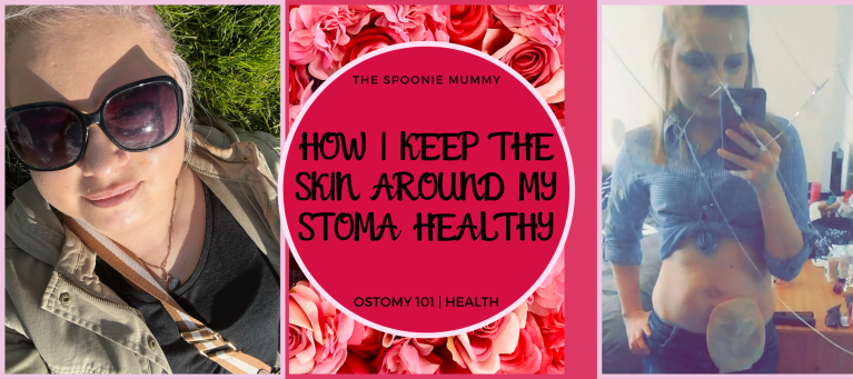 Ostomy 101 – How I Keep The Skin Around My Stoma Healthy – The Spoonie ...